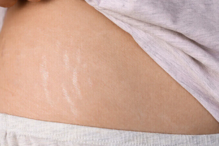 Selain Kehamilan, Ini Sederet Penyebab Timbulnya Stretch Mark di Paha